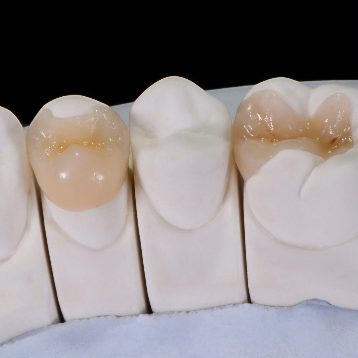 Dental fillings guide: Costs, types, and durability | Blog