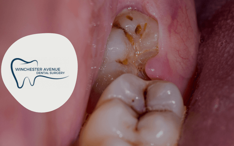 Wisdom Tooth Removal & Recovery | Winchester Avenue Dental